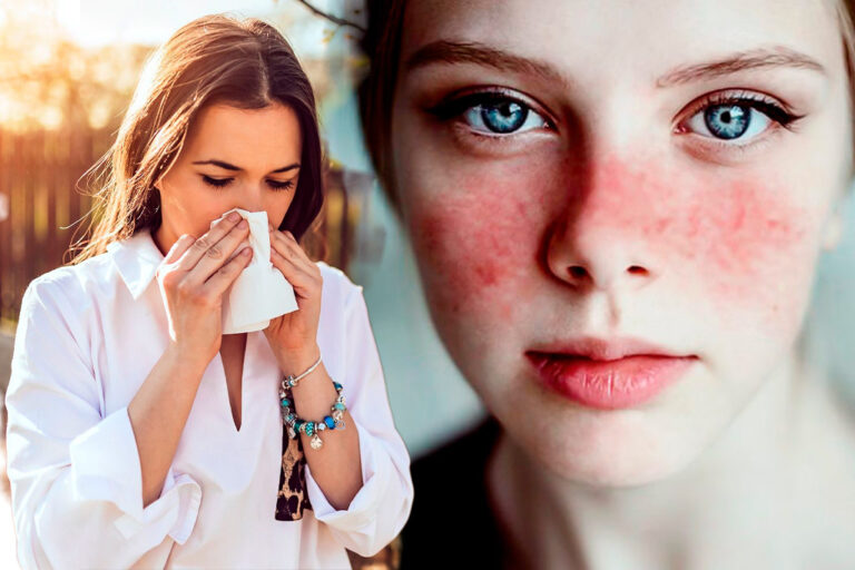 ¿Cuándo la alergia causa granos en la cara? – La Voz Viral